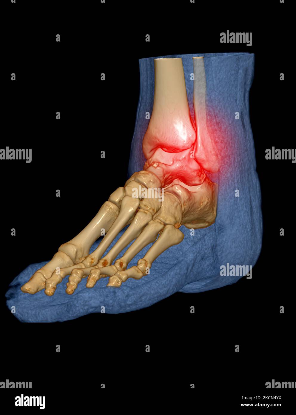 3D rendu des os du pied pour le diagnostic de la fracture osseuse et de ...