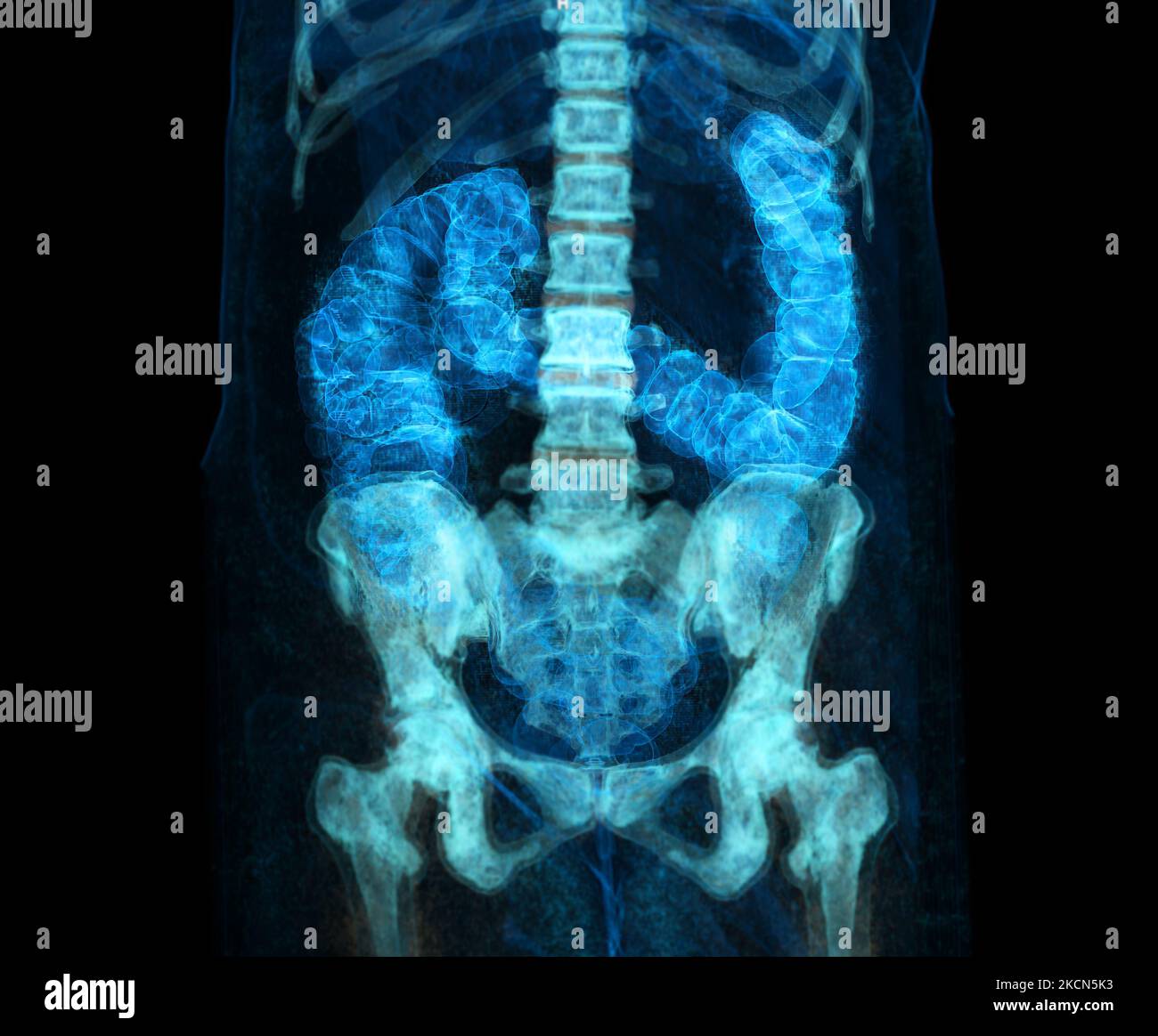 Ct Colonography Ou Ct Scan Of Colon 3d Image De Rendu Pour Le Dépistage