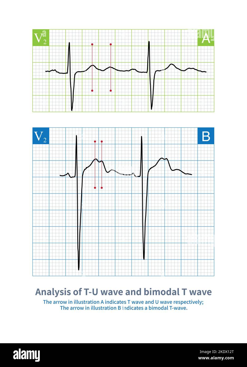 ECG onde U et onde T bimodale, illustration Photo Stock - Alamy