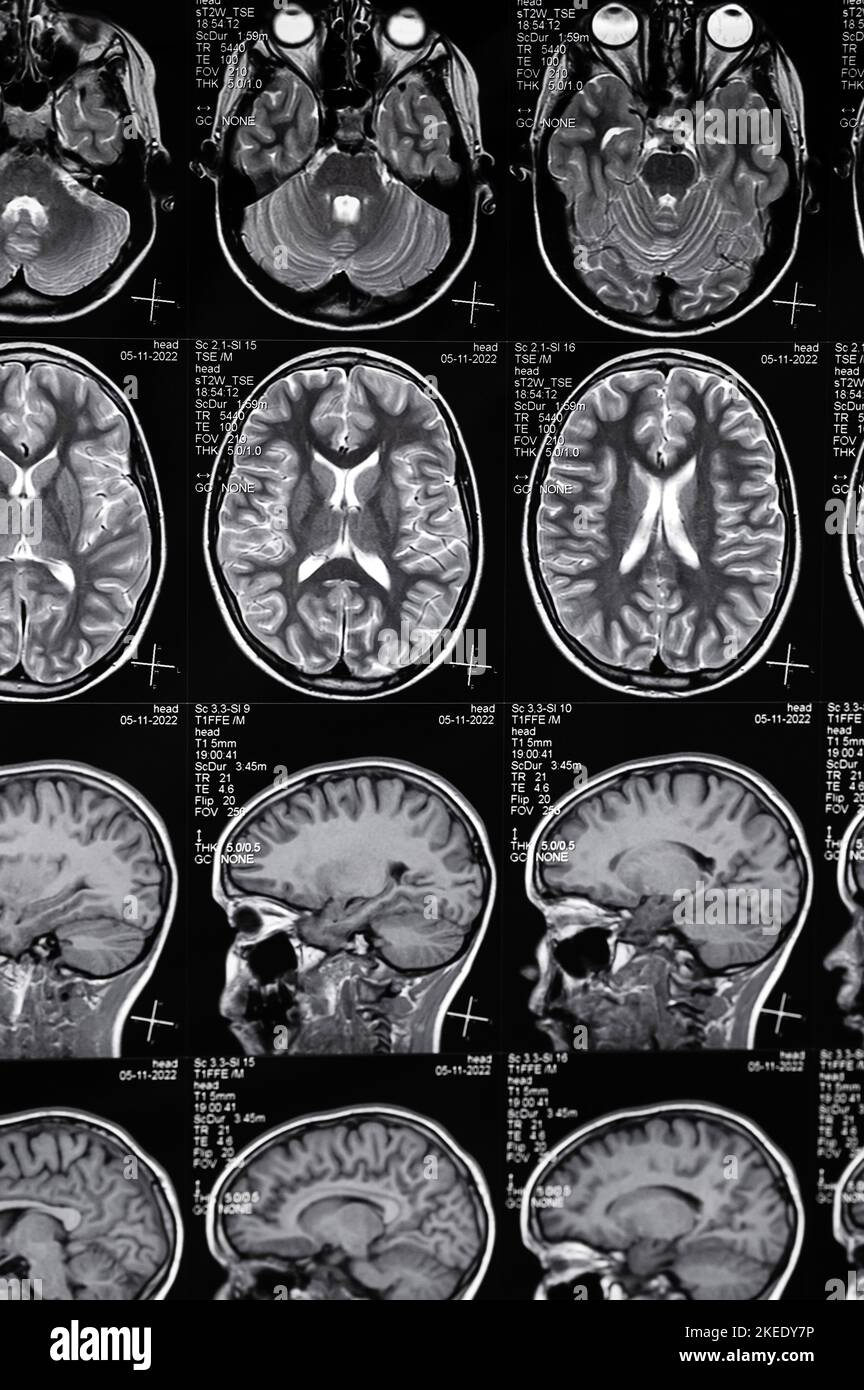 Acquisition d'images par résonance magnétique à haute résolution du ...