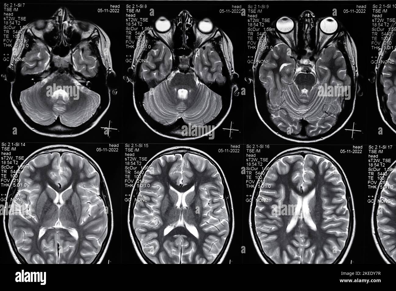 Acquisition d'images par résonance magnétique à haute résolution du ...