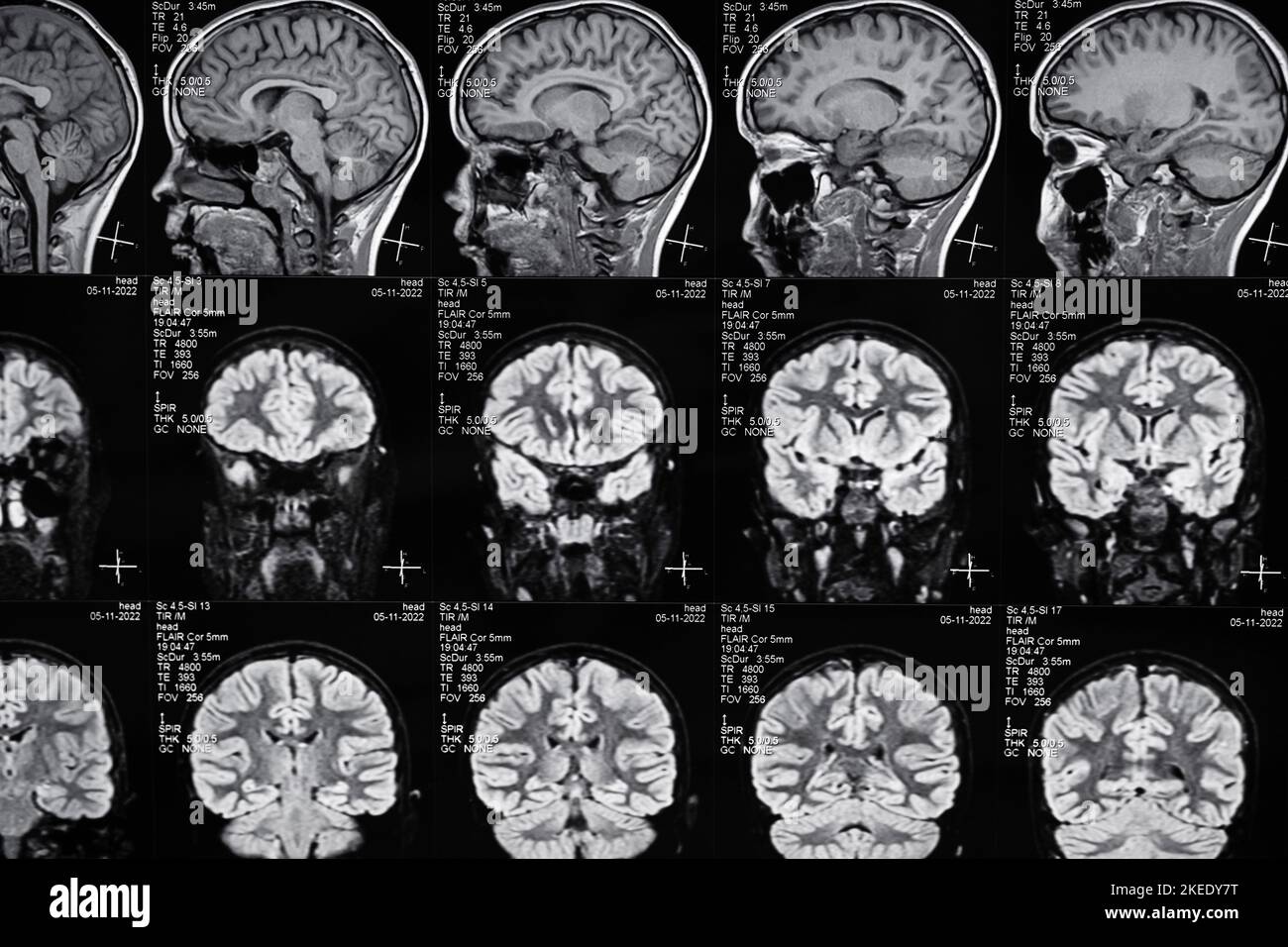 Acquisition d'images par résonance magnétique à haute résolution du ...