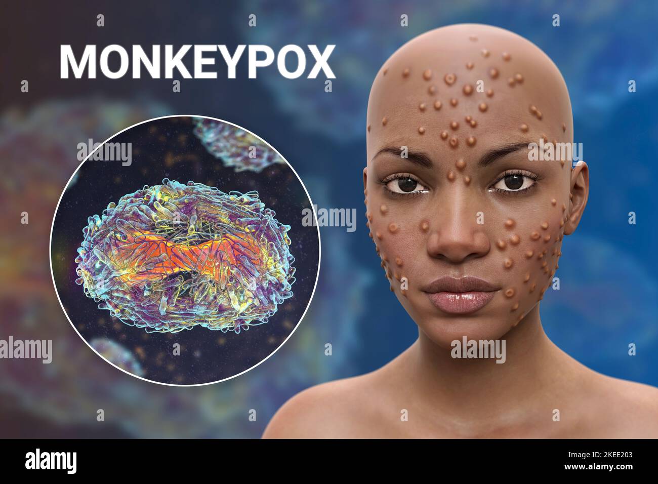 Patient atteint d'une infection à la variole du singe, illustration de ...