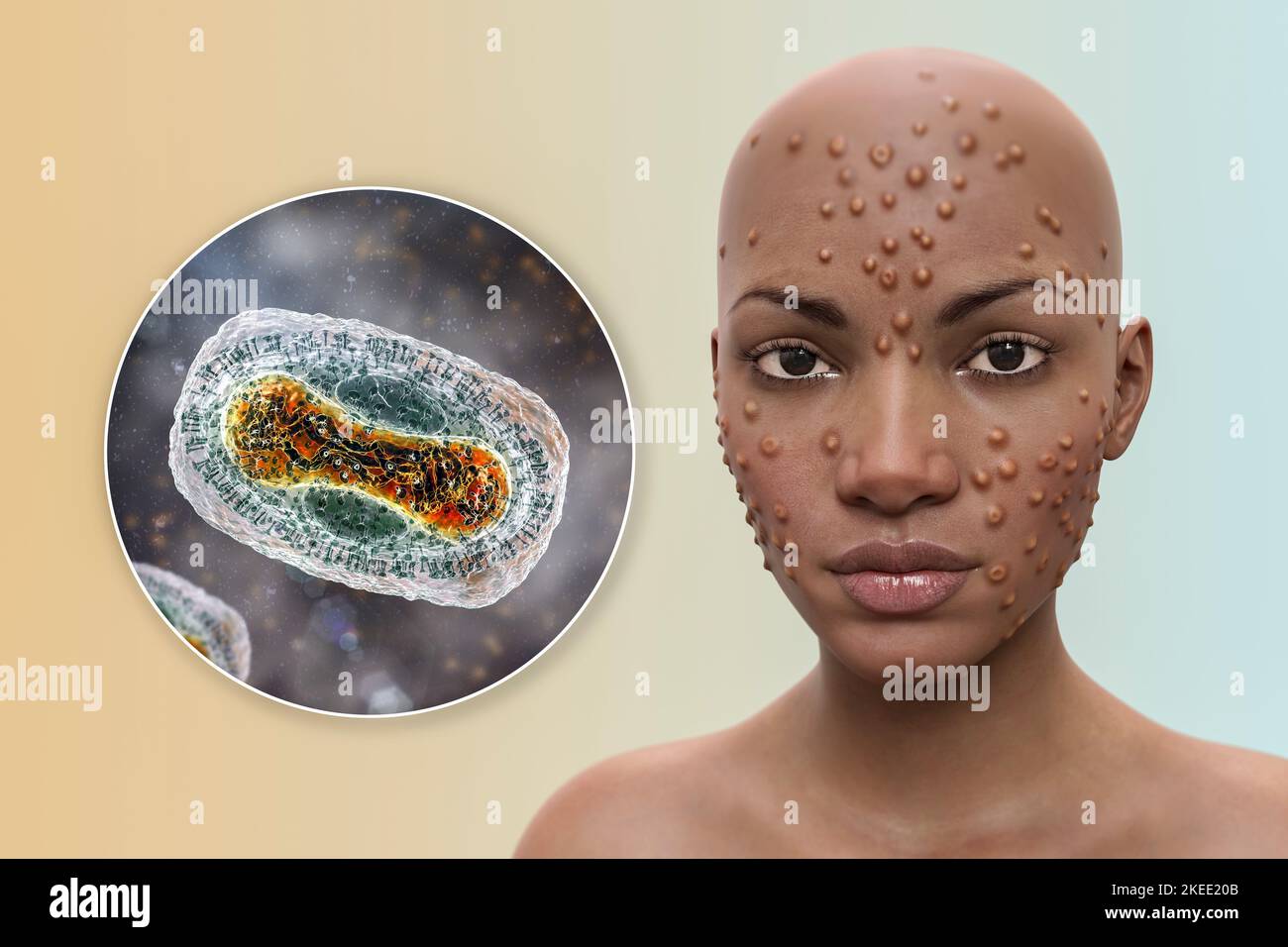 La variole du singe structure de virus Banque de photographies et d ...