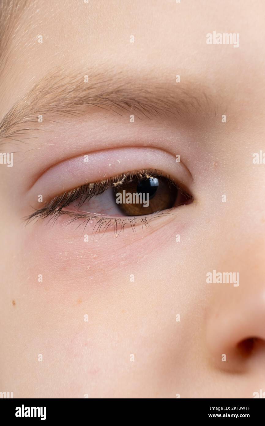 Conjonctivite oculaire Banque de photographies et d’images à haute ...
