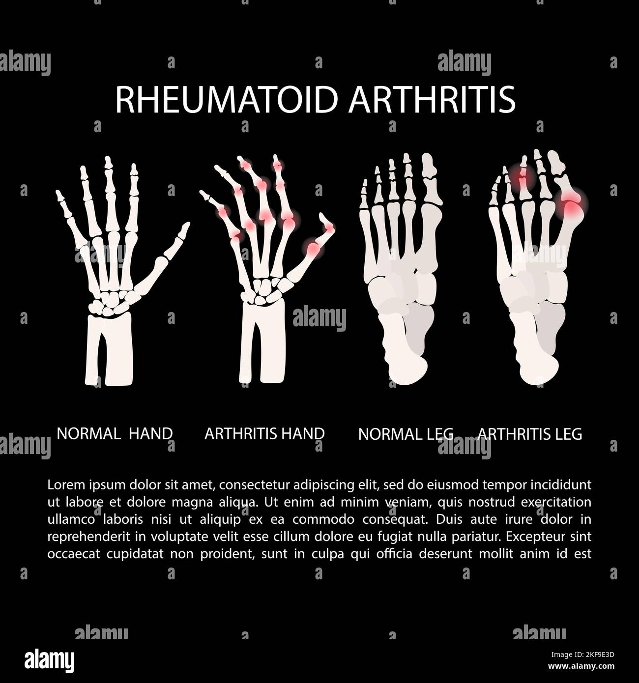 ARTHRITE JAMBE MANUELLE polyarthrite rhumatoïde maladie chronique ...