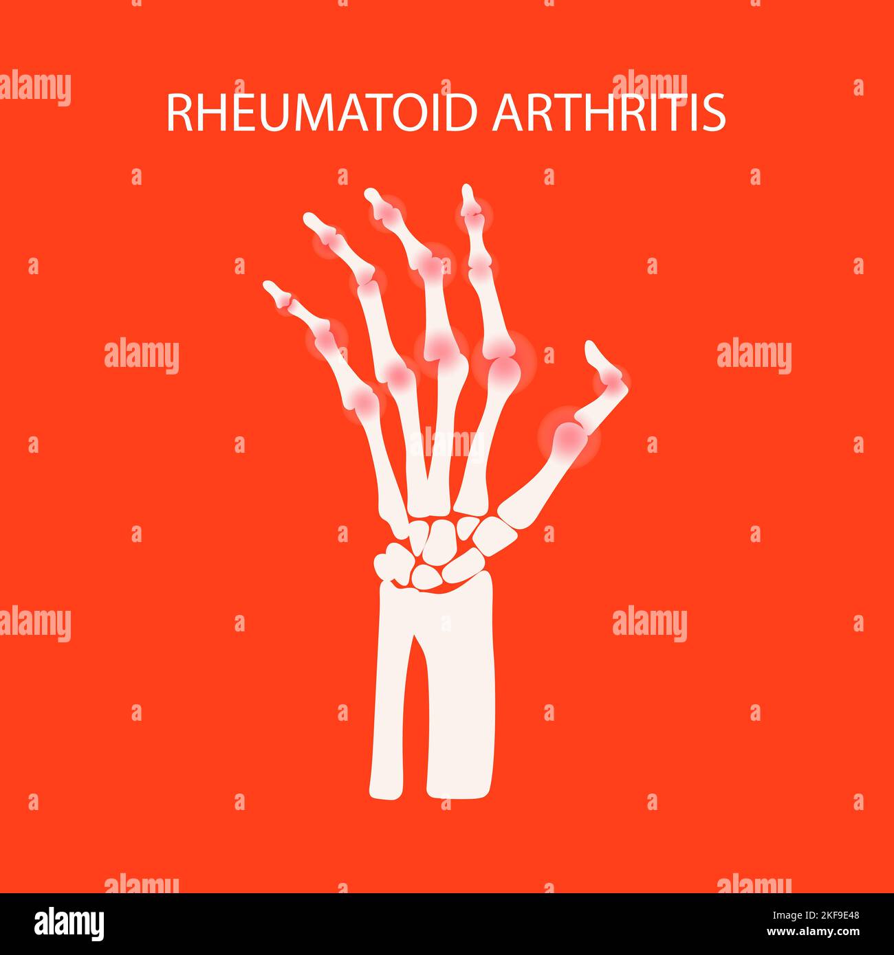 ARTHRITE MAIN polyarthrite rhumatoïde maladie chronique médecine Schéma ...