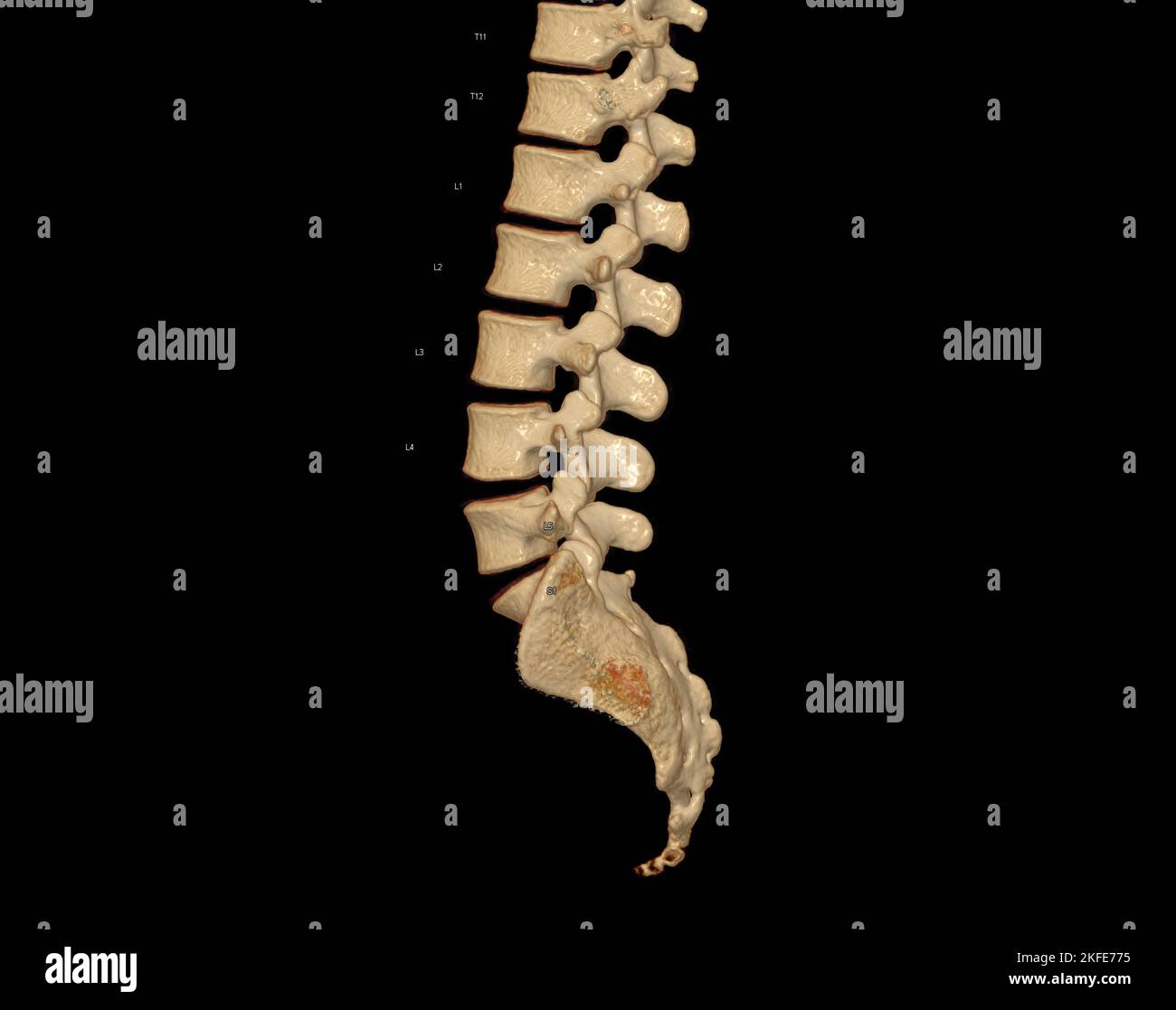 Acquisition CT du rendu du rachis lombaire 3D montrant le profil du ...