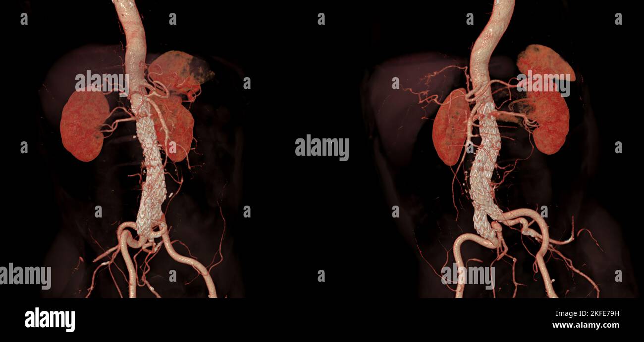 CTA aorte entière avec endoprothèse d'aorte abdominale, comparer l ...