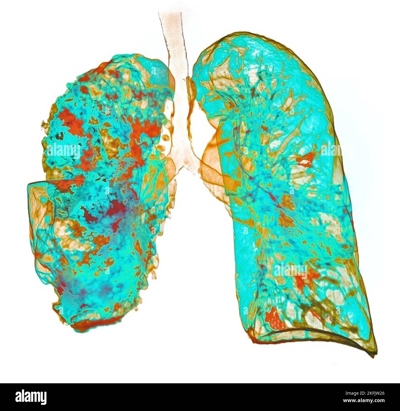 Xray of abnormal lung Banque d'images détourées - Alamy