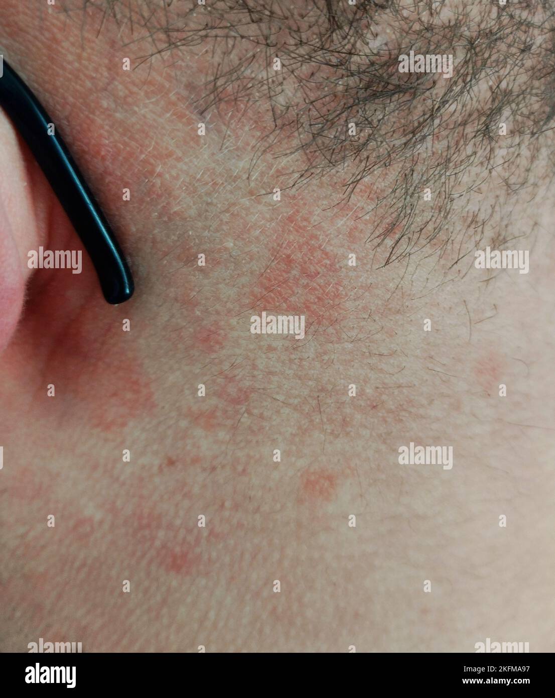 Infection fongique Banque de photographies et d’images à haute ...