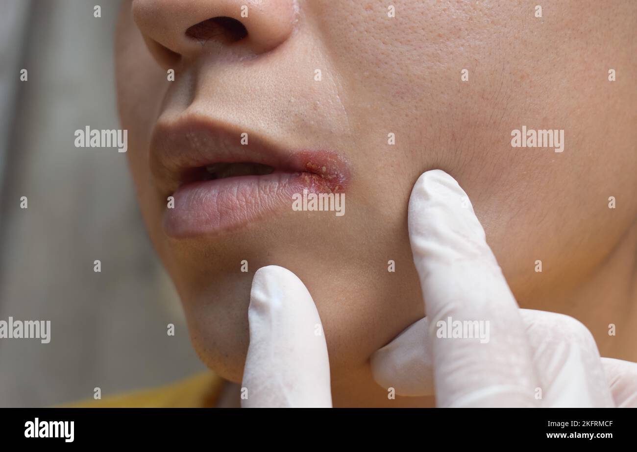 Stomatite angulaire ou chéilite angulaire ou perleche chez le jeune homme asiatique. Ulcère ...