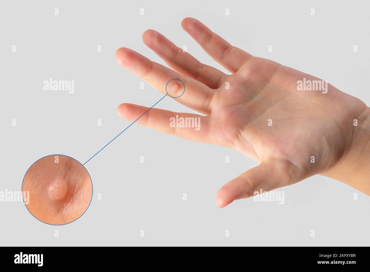 Gauchissement sur le doigt. Gros plan d'une verrue sur le doigt d'un ...