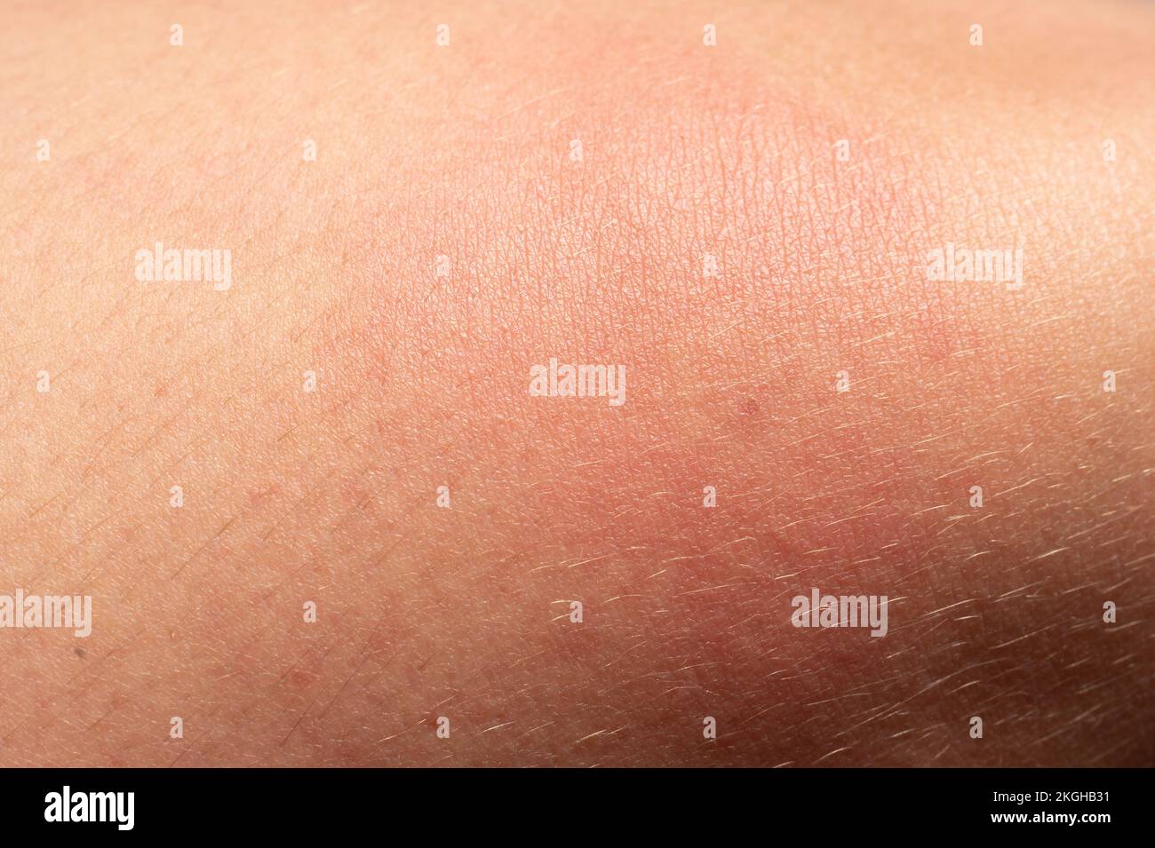 Allergie sur le corps humain et rougeur de la piqûre de guêpe, rougeur ...