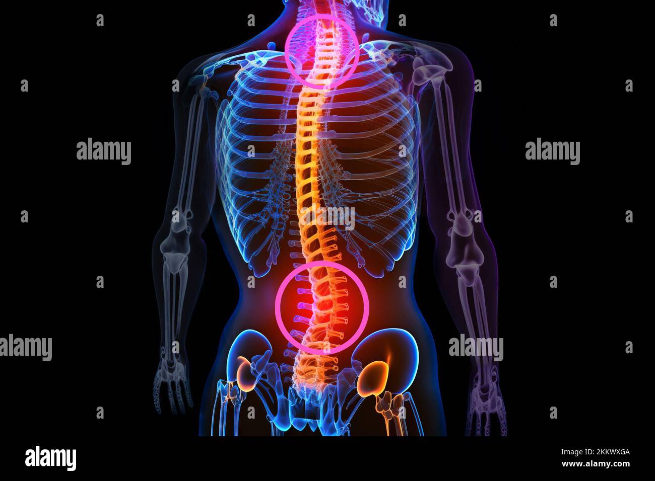 Scoliosis of the spine Banque de photographies et d’images à haute ...