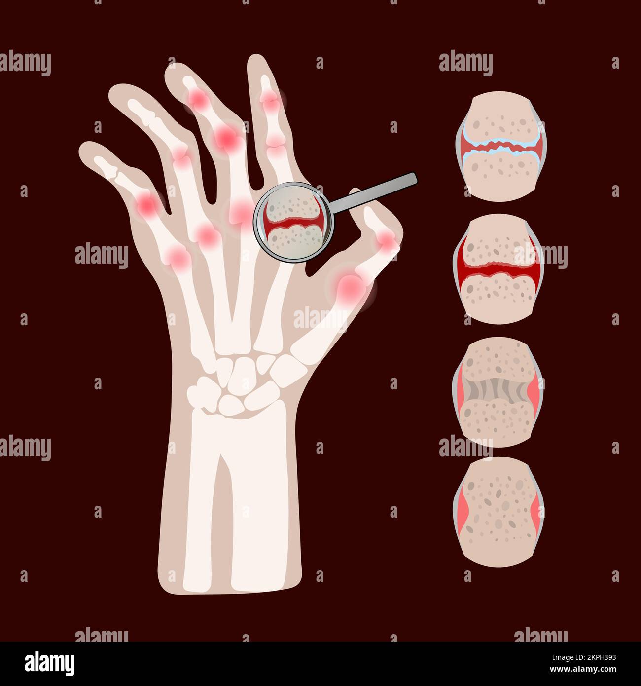 MALADIE RHUMATOÏDE arthrite Schéma de lésions des mains humaines pour ...