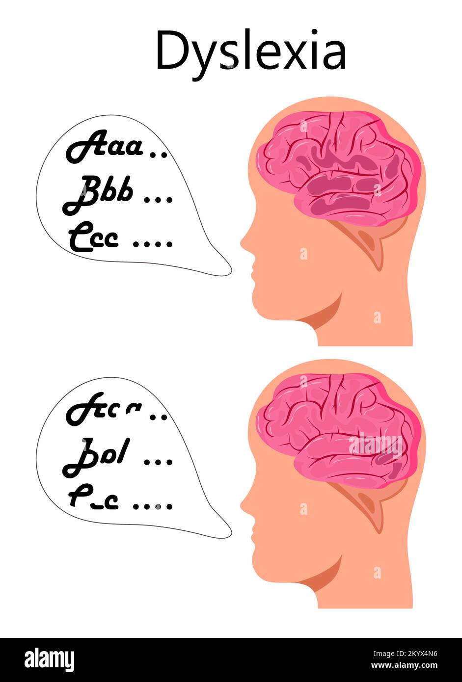 Dyslexie dans le cerveau humain Banque d'images vectorielles - Alamy