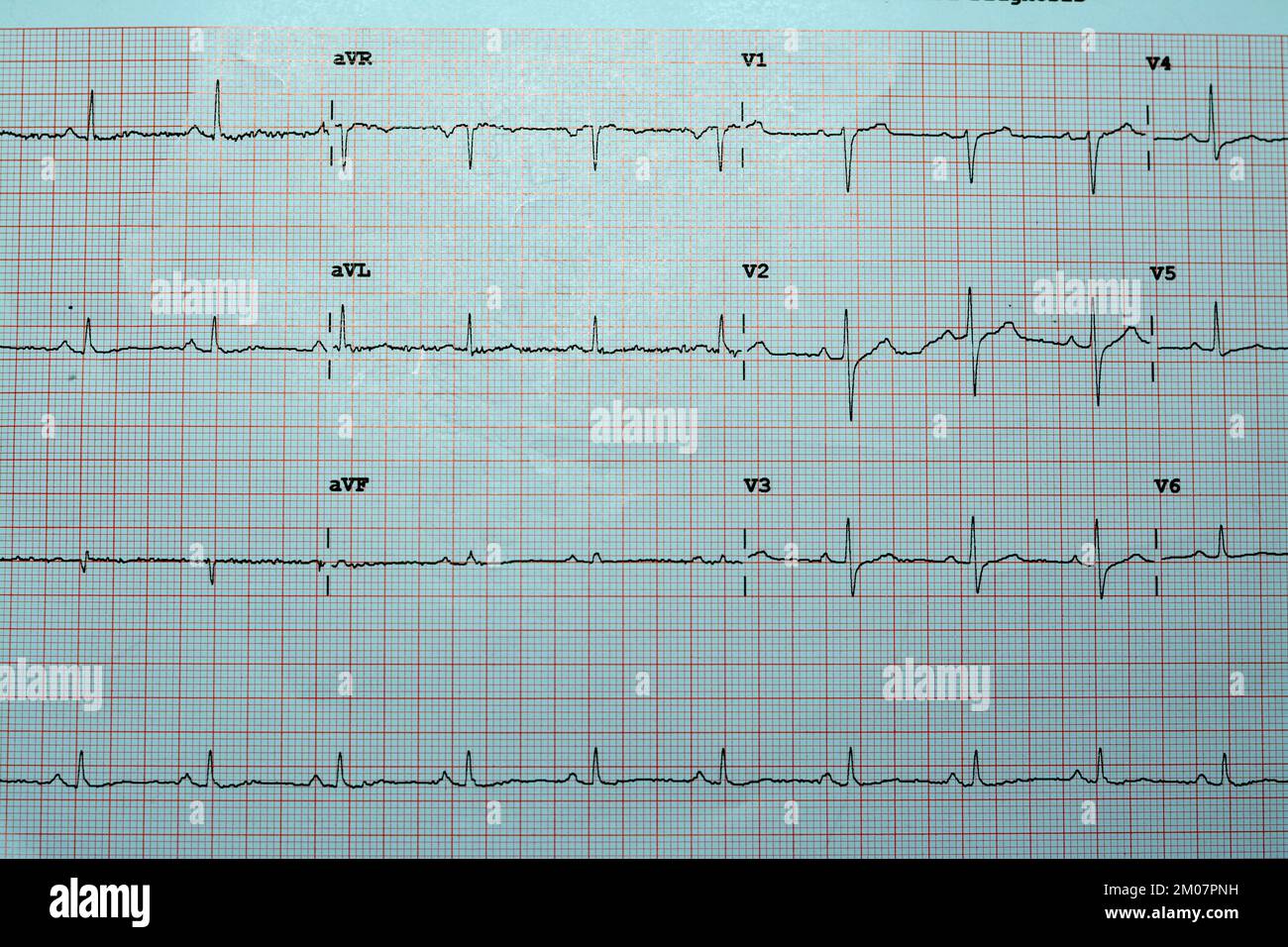 Un ECG d'électrocardiographe, un graphique qui tire l'électricité du ...