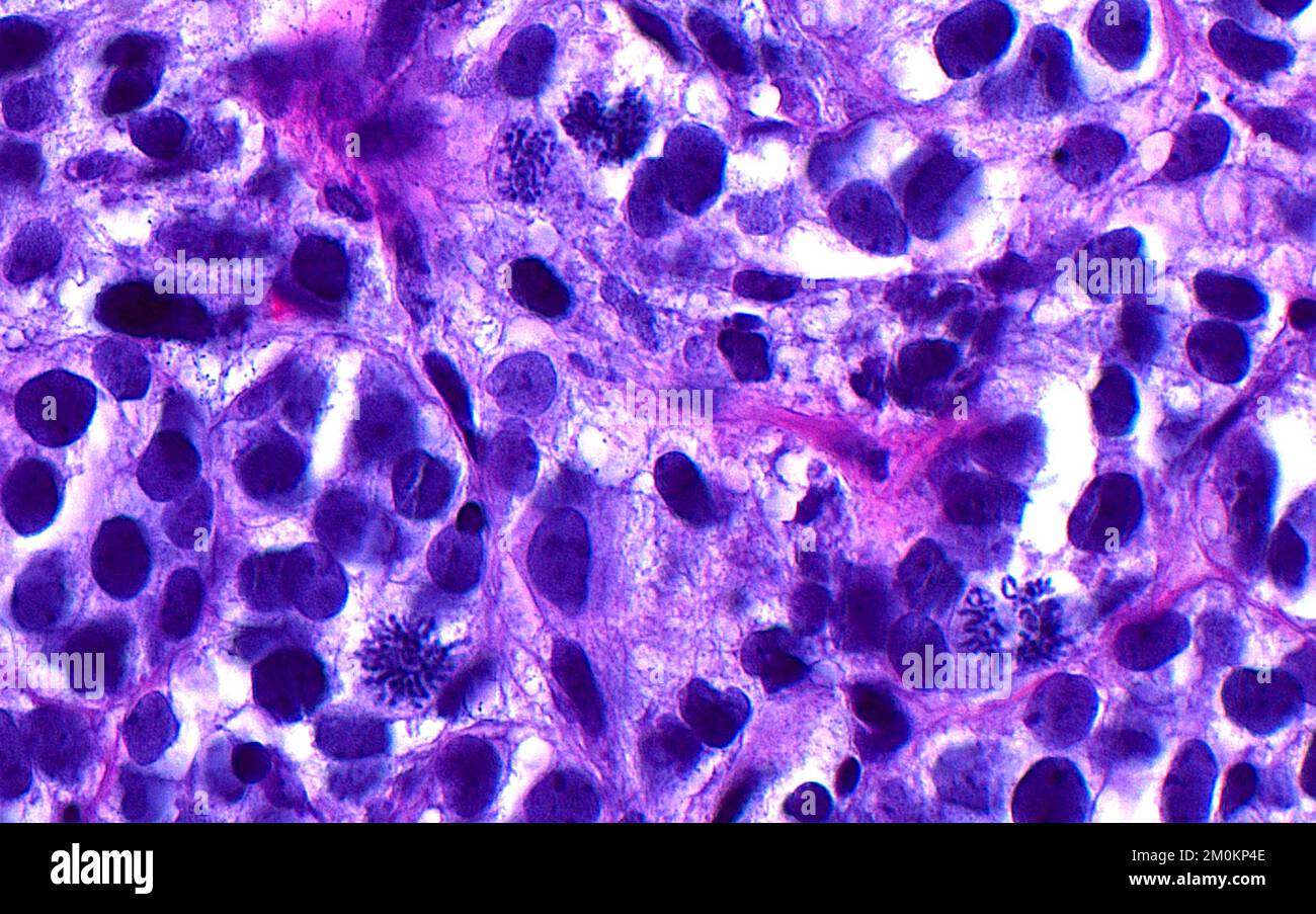 Cellules cancéreuses de la vessie avec mitoses, micrographe léger Photo ...