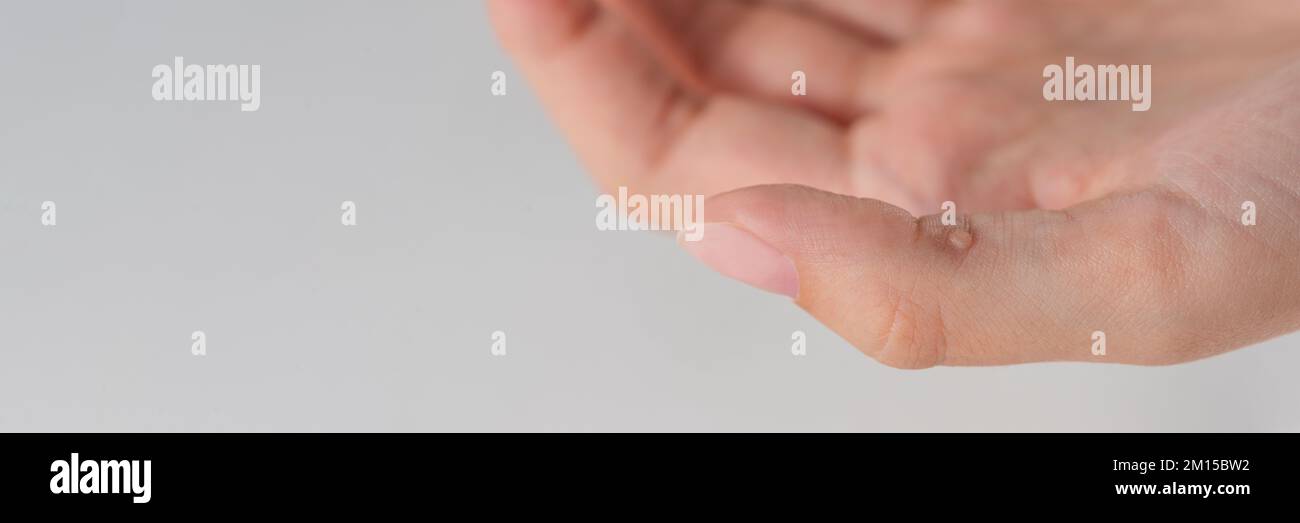 Gauchissement à portée de main. Le concept de traiter les verrues et ...