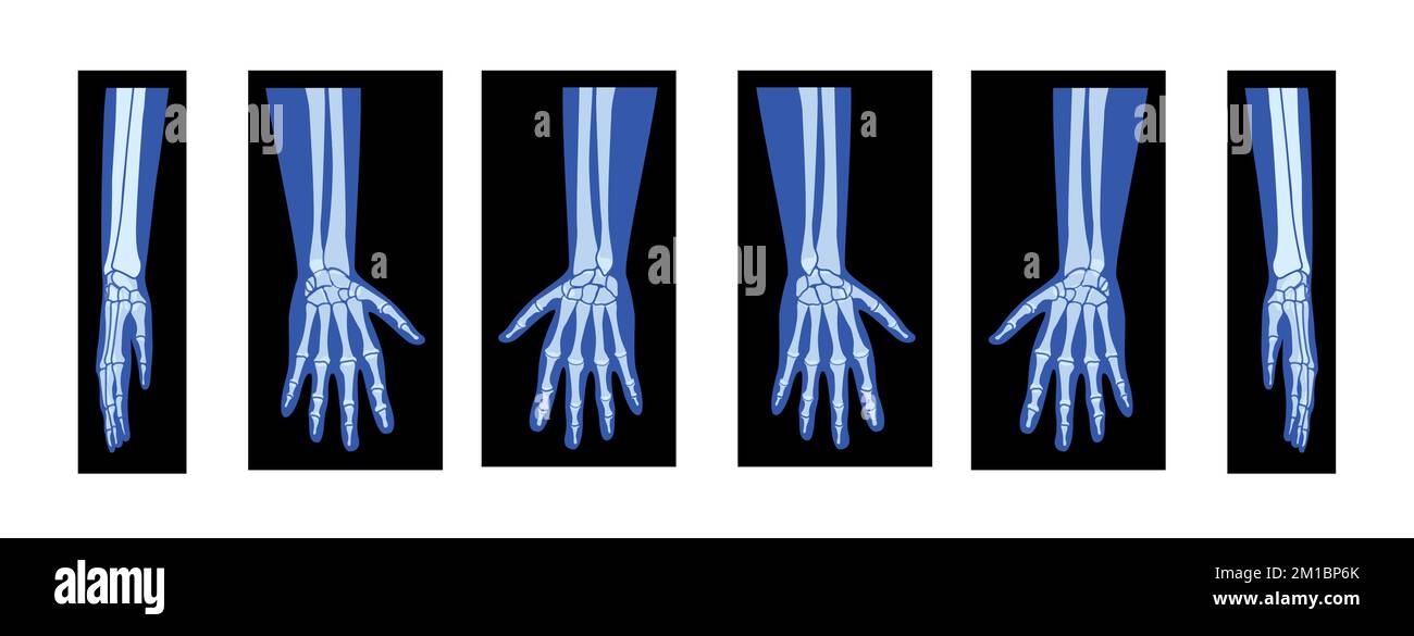 Ensemble de mains X-Ray avec rayon, Ulna Skeleton corps humain, os ...