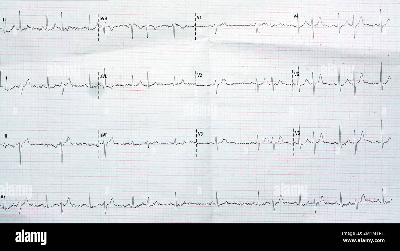 Papier d'électrocardiographe ECG présentant un NSR de rythme sinusal ...