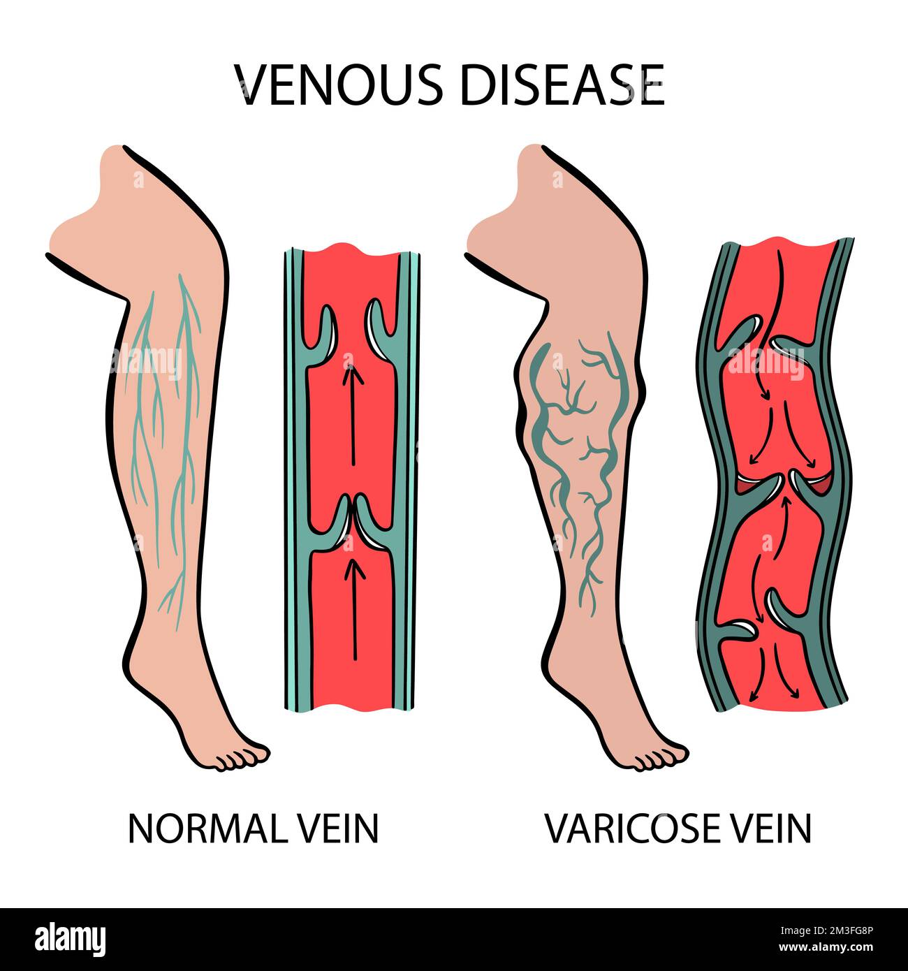 MALADIE VEINEUSE varices des jambes humaines torsion et dilation des ... MALADIE VEINEUSE varices des jambes humaines torsion et dilation des ...