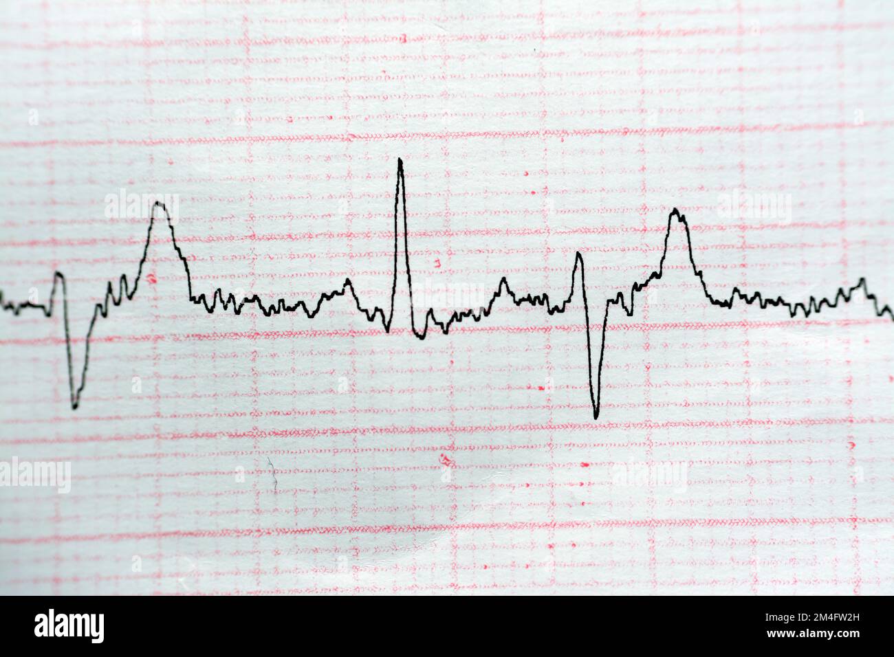 Papier d'électrocardiographe ECG présentant un NSR de rythme sinusal ...