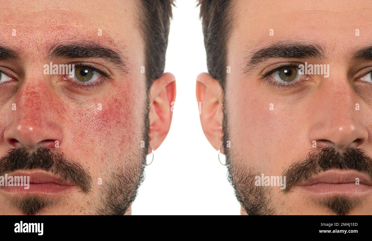 Acné rosacée sur le nez Banque de photographies et d’images à haute ...