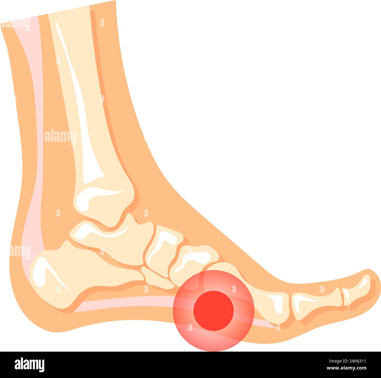 Douleur à la jambe. Tache rouge dans le pied humain. Illustration ...