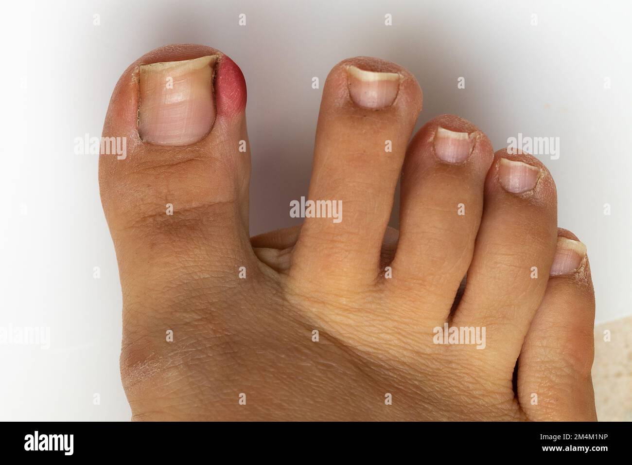 Macro d'un gros orteil de femme avec un ongle de pied incarné. Peau rouge et gonflée en raison ...