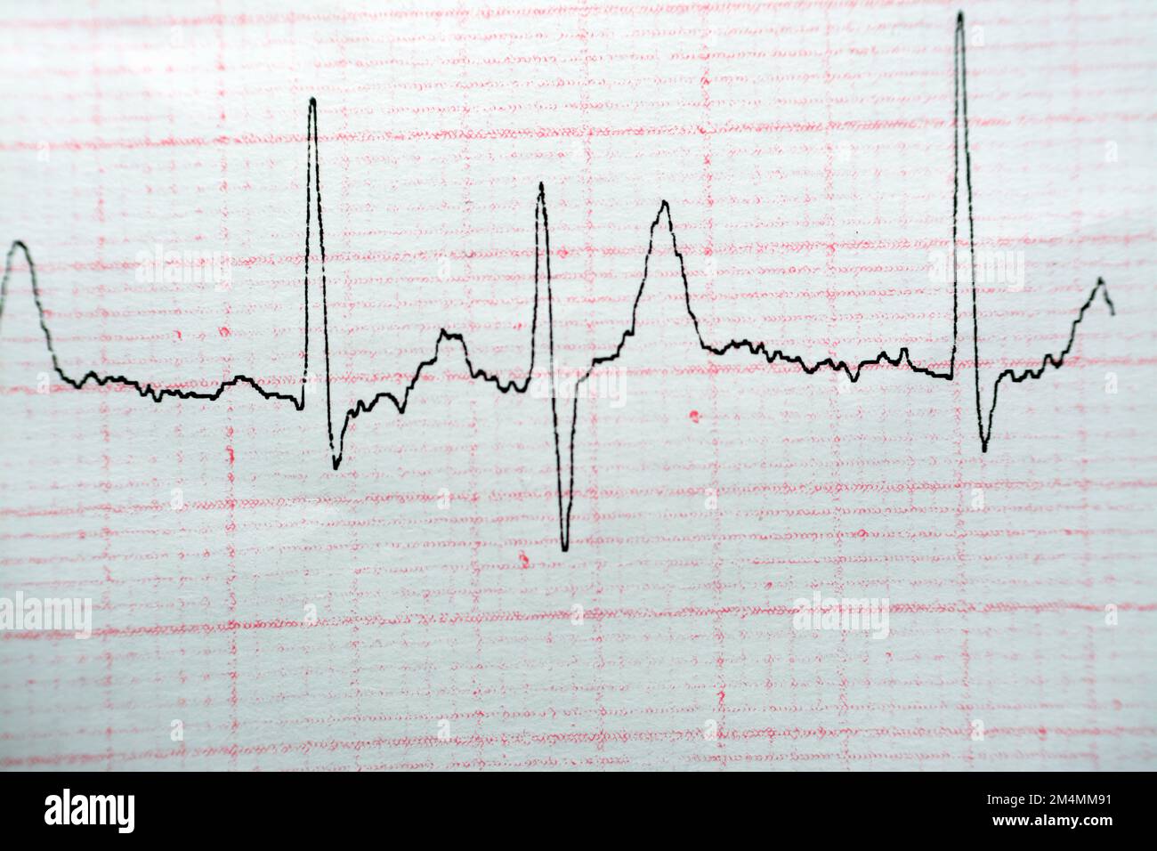 Papier d'électrocardiographe ECG présentant un NSR de rythme sinusal ...