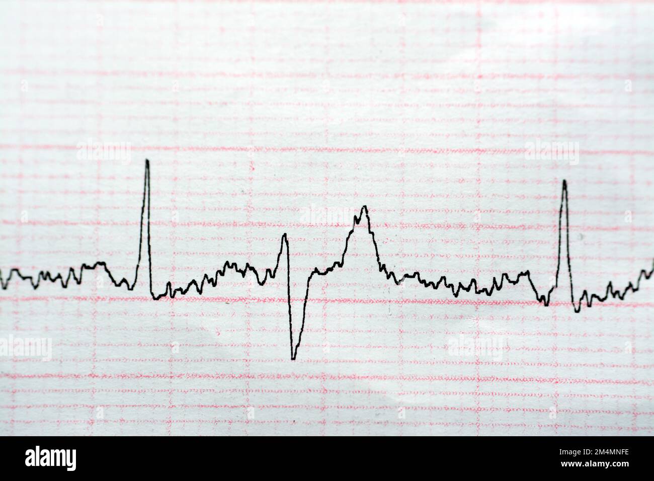 Papier d'électrocardiographe ECG présentant un NSR de rythme sinusal ...