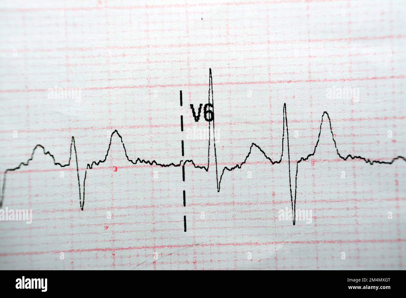 Papier d'électrocardiographe ECG présentant un NSR de rythme sinusal ...