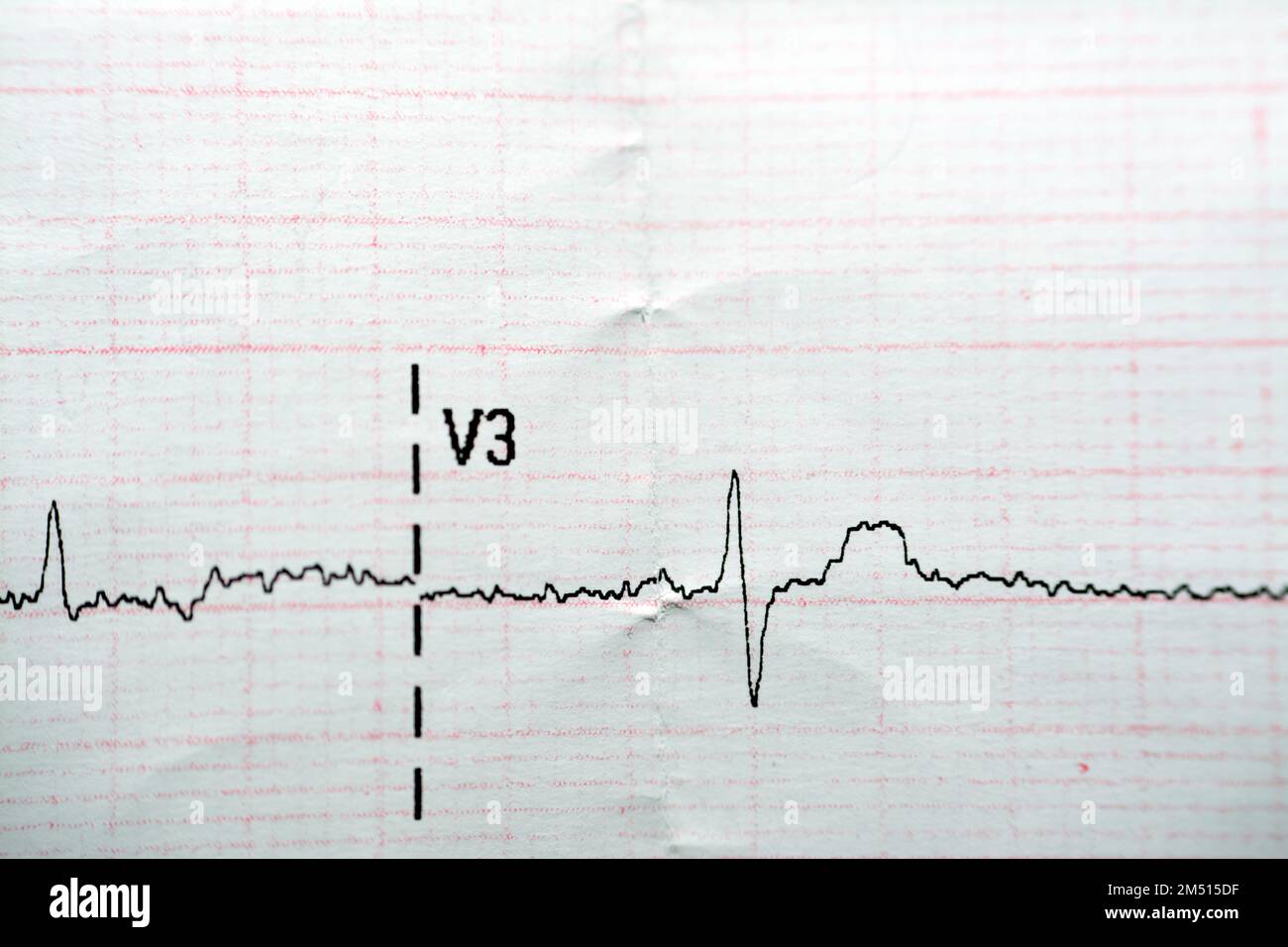Papier d'électrocardiographe ECG présentant un NSR de rythme sinusal ...