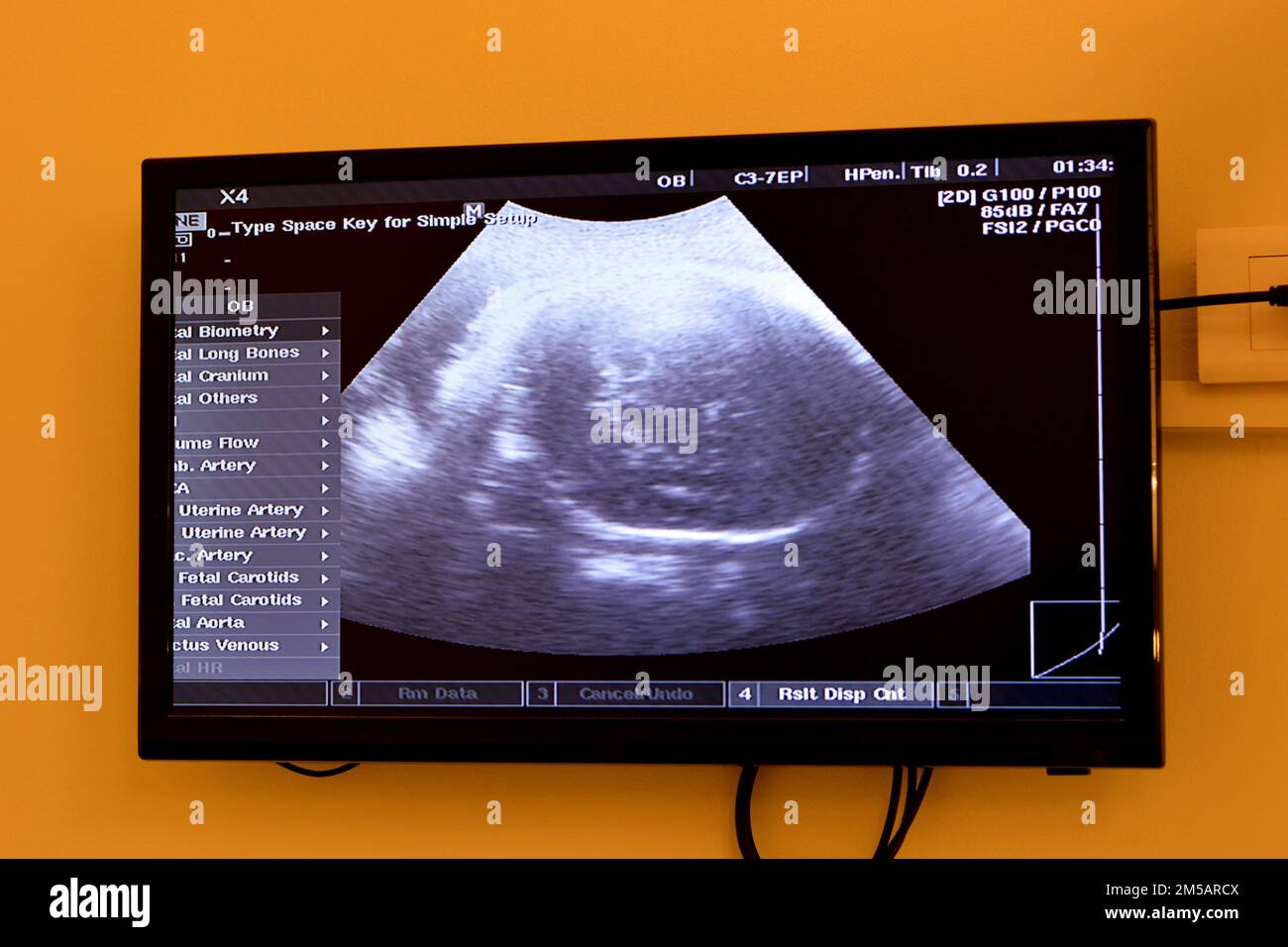 Échographie sur l'utérus d'une femme enceinte montrant un fœtus en ...