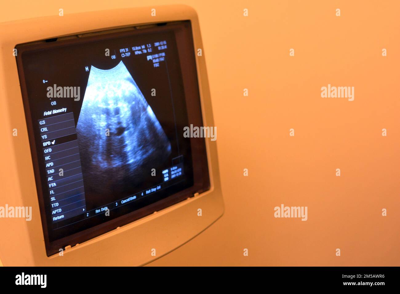 Échographie Sur Lutérus Dune Femme Enceinte Montrant Un Fœtus En