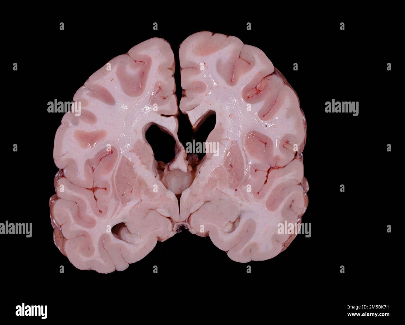 Spécimen brut d'une coupe du cerveau humain montrant une épendymome ...