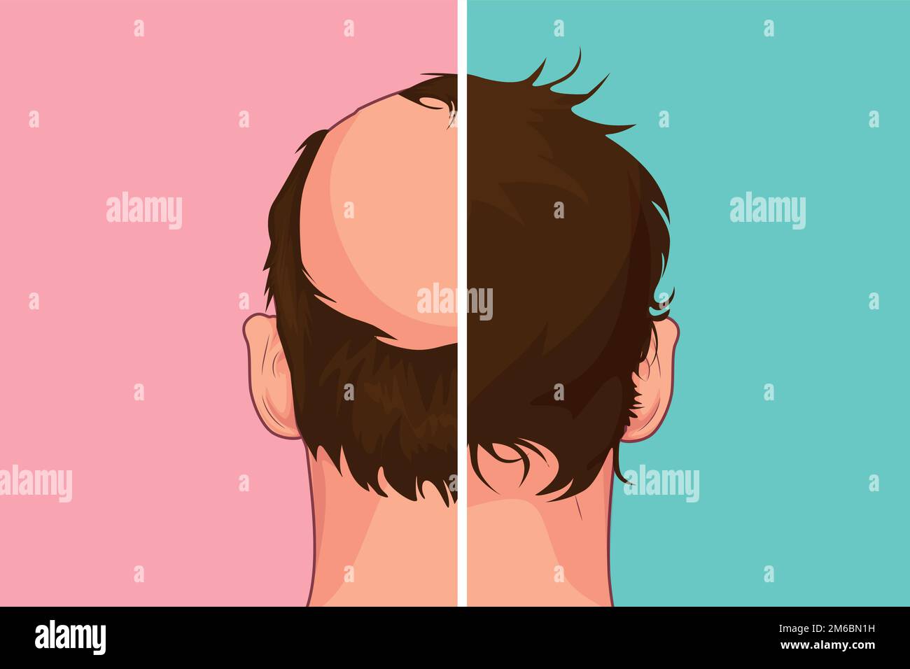 Perte de cheveux. Stades de l'alopécie homme problème vecteur santé ...
