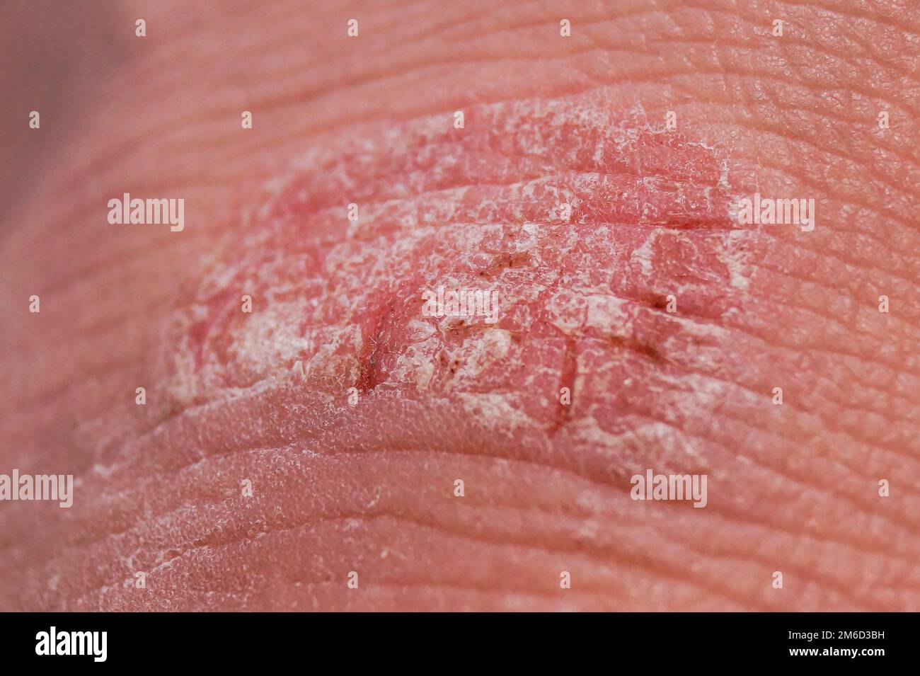 Psoriasis en plaques Banque de photographies et d’images à haute ...