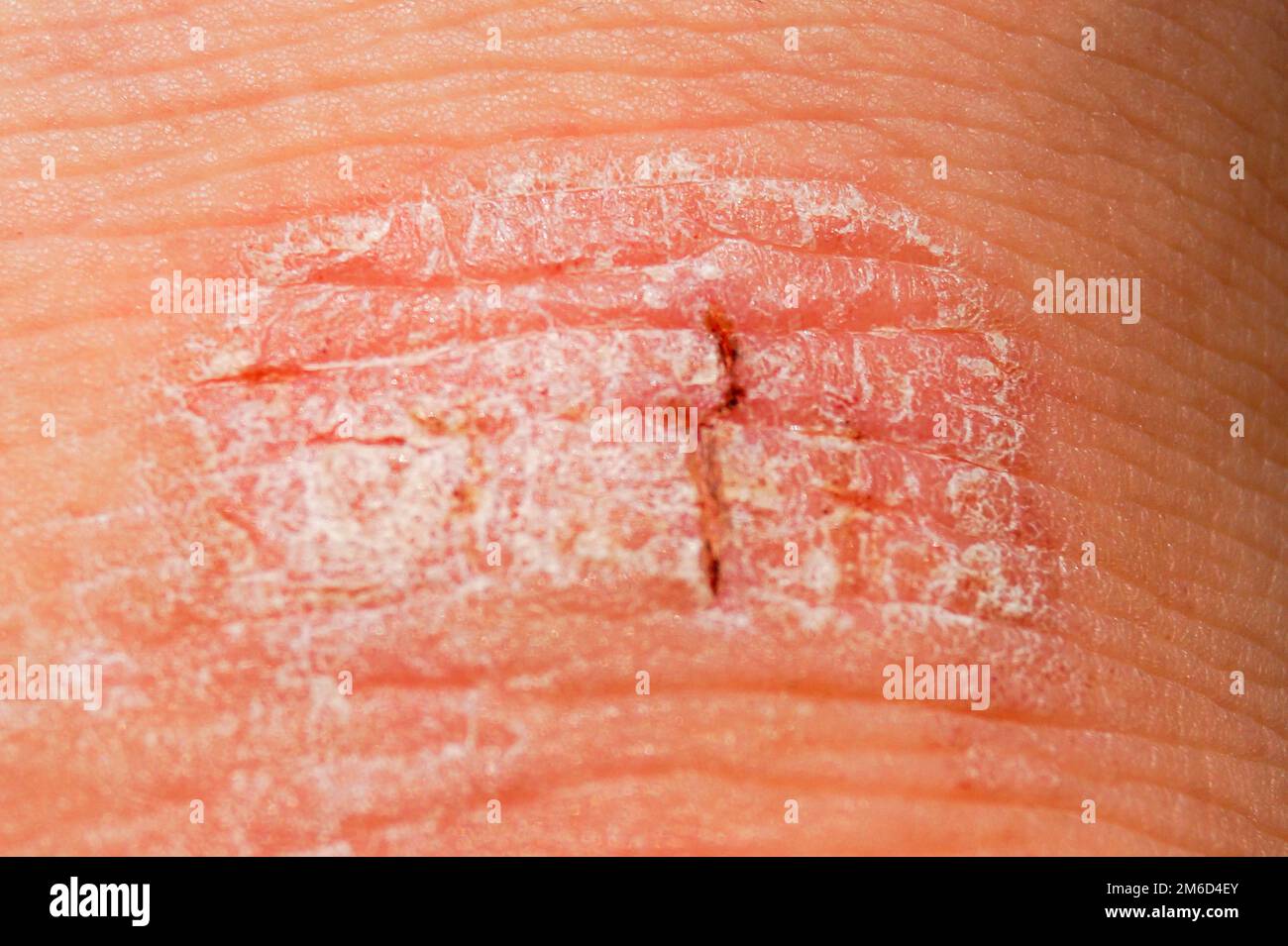 Psoriasis en plaques Banque de photographies et d’images à haute ...