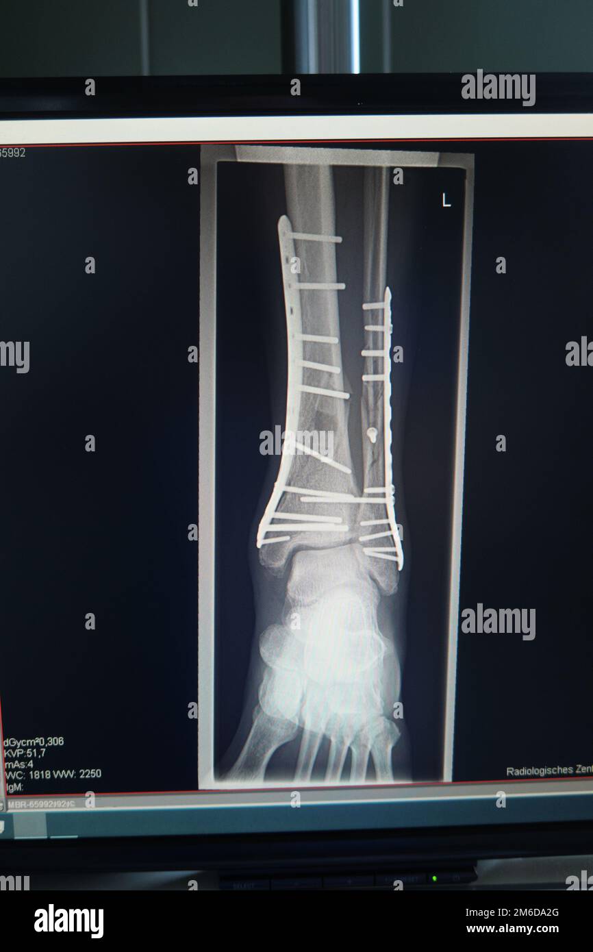 Une radiographie montre une fracture de l'articulation de la cheville ...