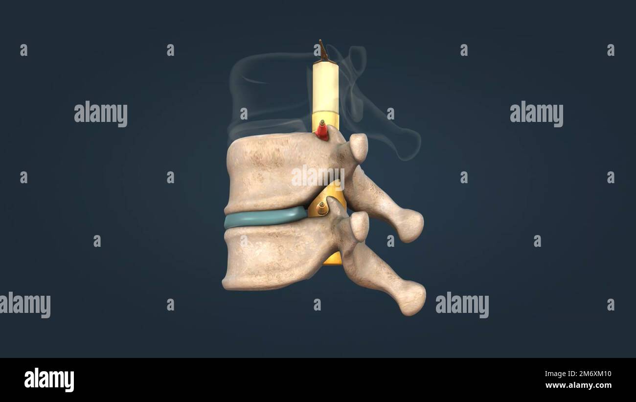 Le nerf spinal est un nerf mixte qui transporte des signaux moteurs ...