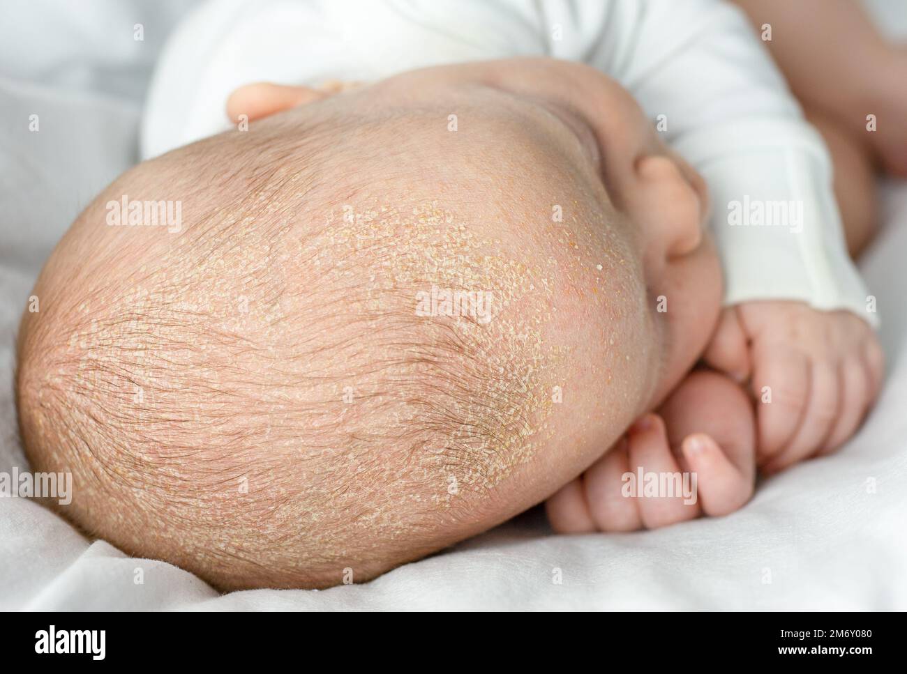 la dermatite séborrhéique crose sur la tête du bébé. enfant avec ...