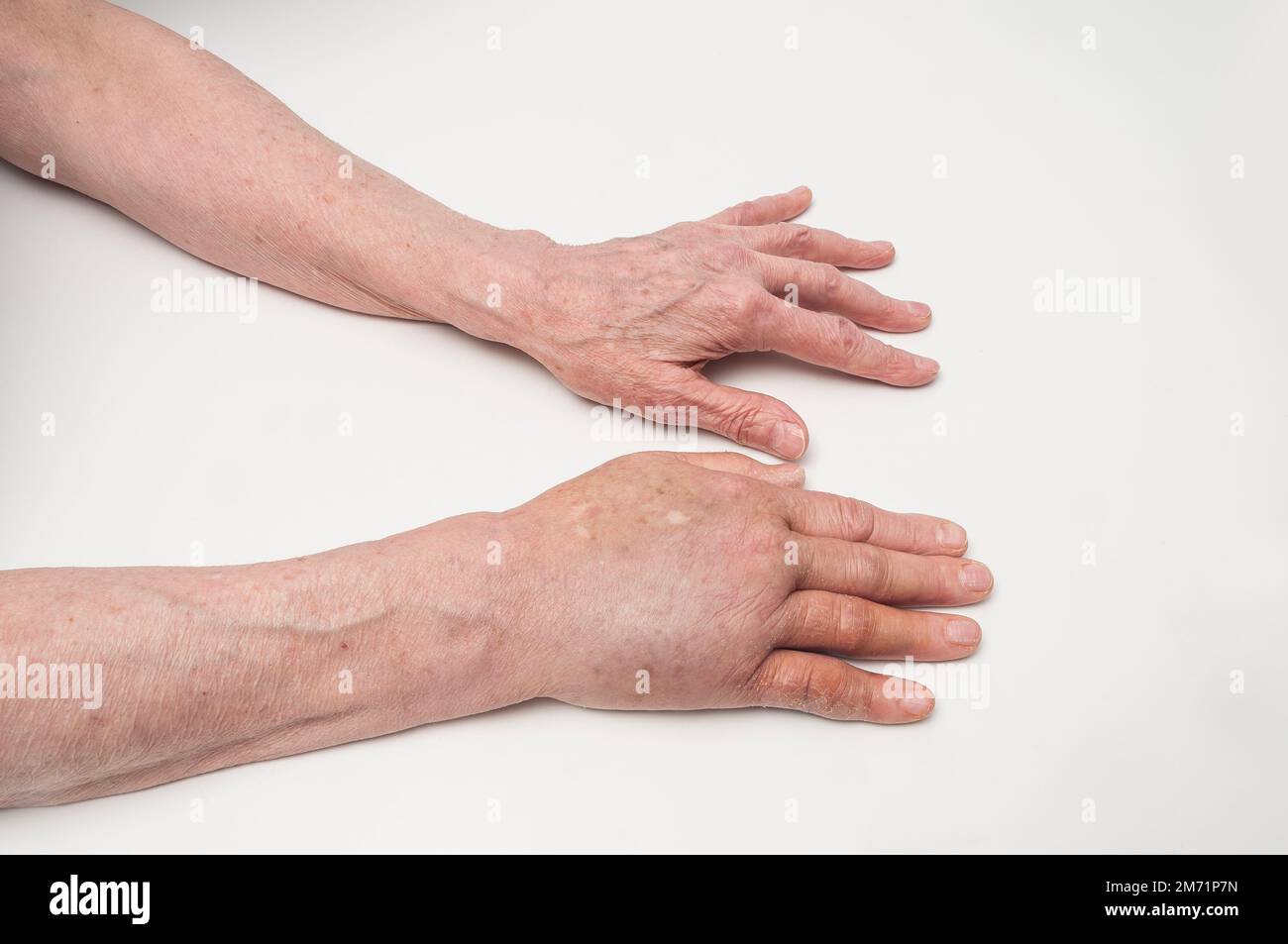 Haut de la postopératoire gonflement de la contracture de Dupuytren ...