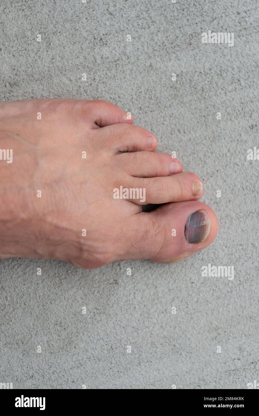 gros plan de l'ongle de l'orteil ecchymose hemtoma. orteil clou ...