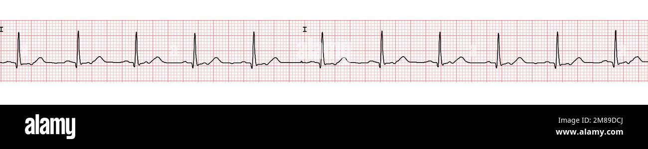 Un rythme sinusal Banque de photographies et d’images à haute ...