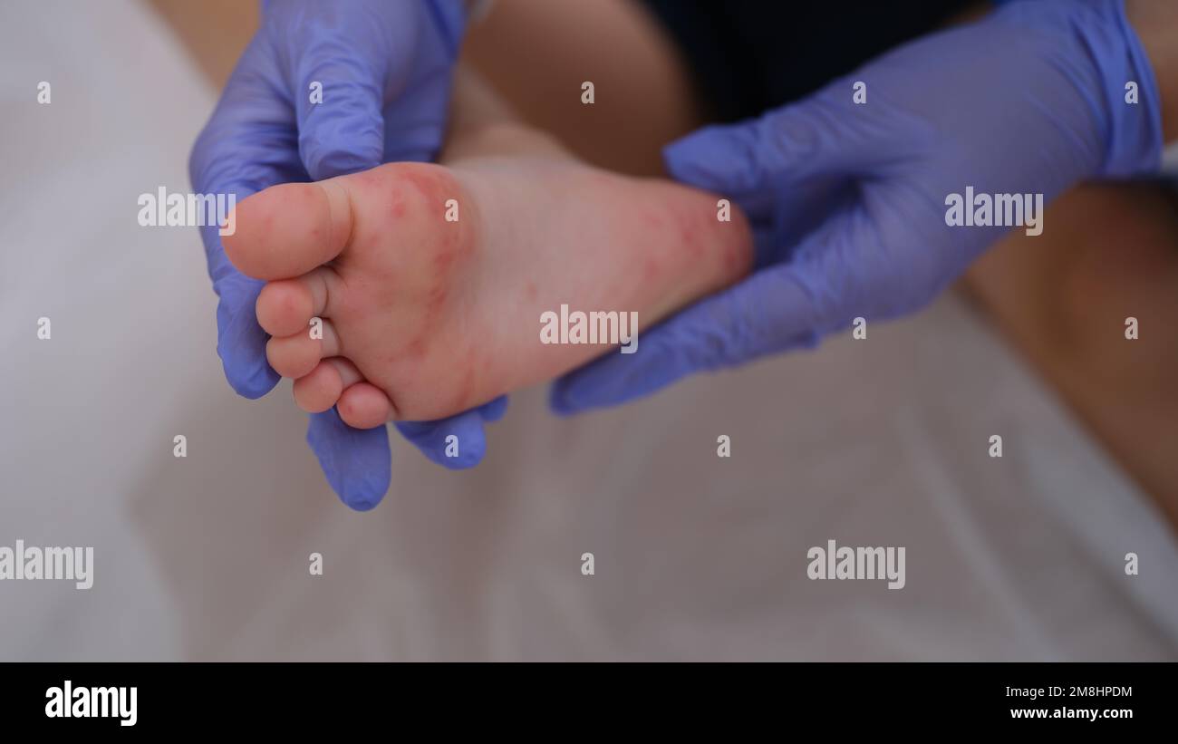 Éruption cutanée avec infection à entérovirus de la famille des ...