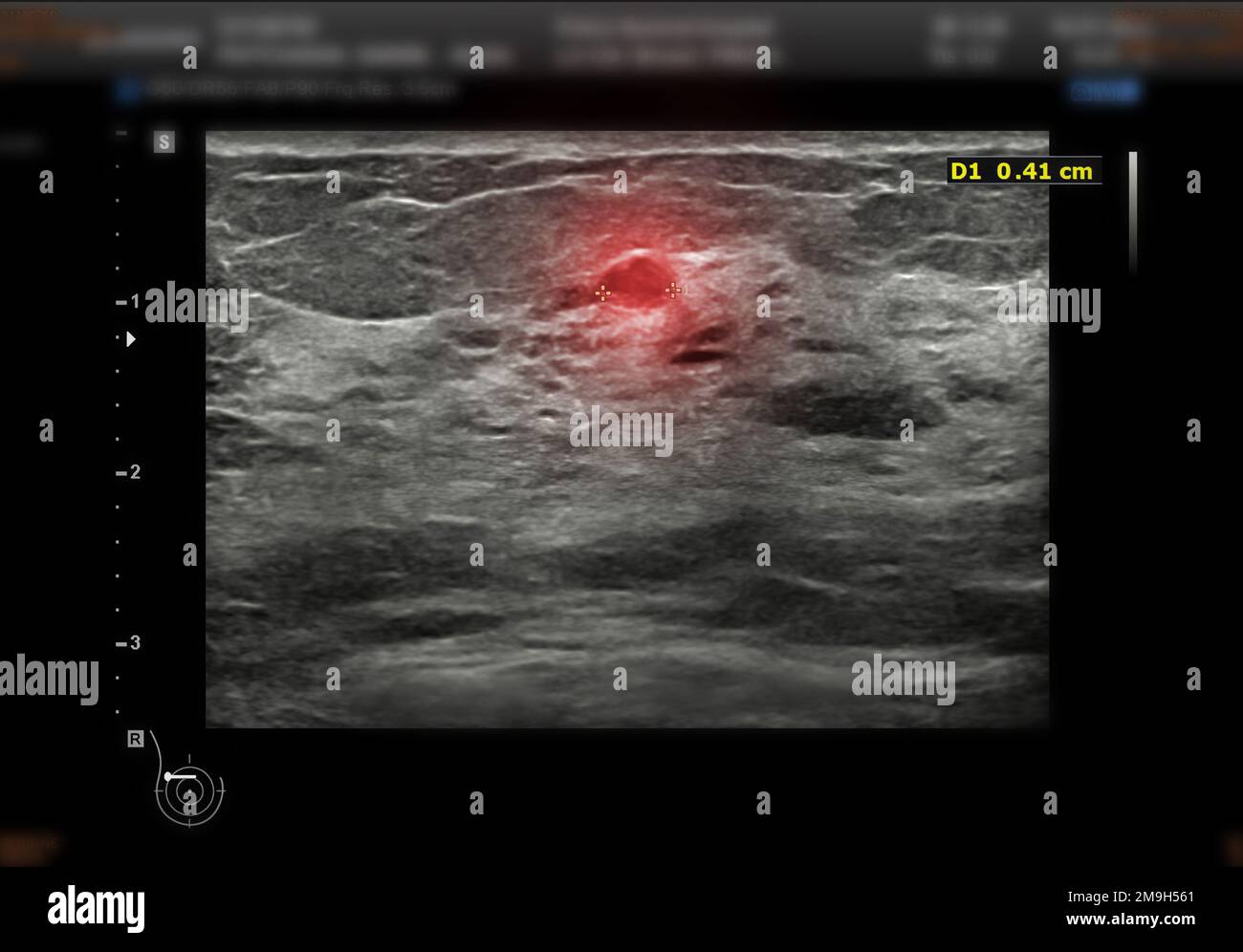 Échographie mammaire du patient après mammographie pour diagnostic ...