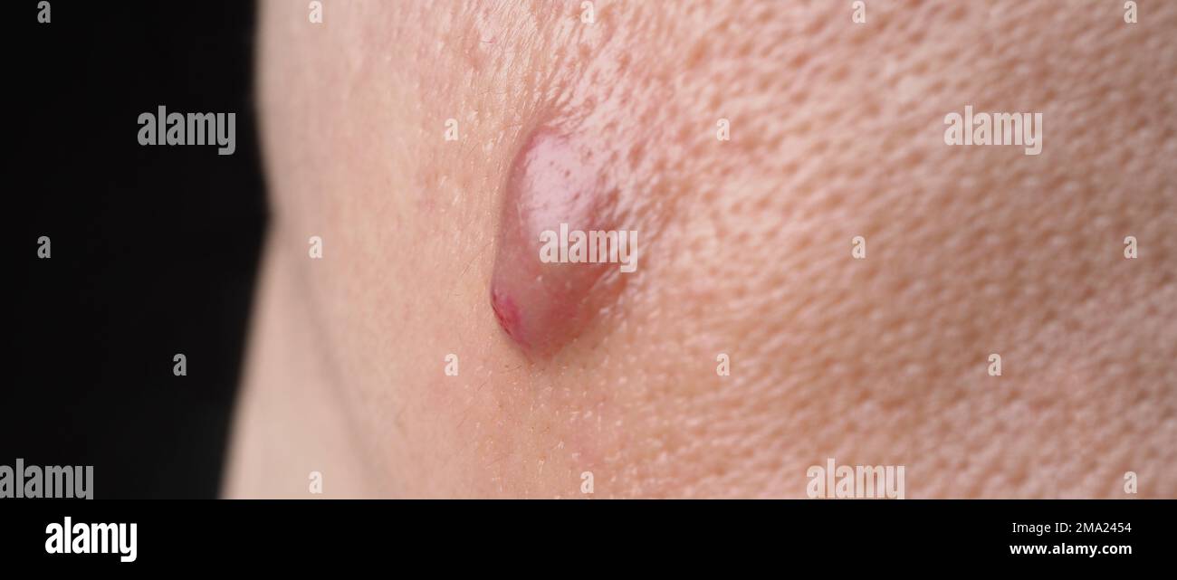 Infection bactérienne de la peau. Grand kyste d'acné abcès ou ulcère ...